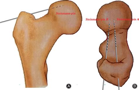 “in‐out‐in” Percutaneous Reduction Technique For Treatment Of Valgus