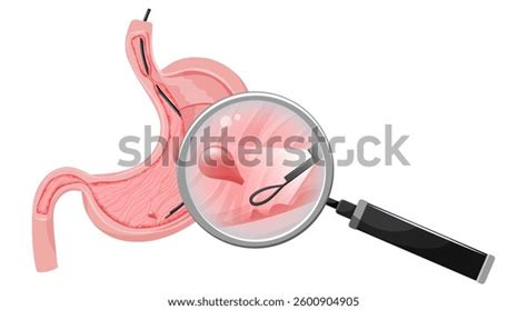 Endoscopic Polyp Removal Stomach Procedure Removing Stock Vector