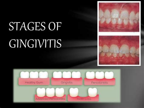Clinical Features And Stages Of Gingivitis Pptx
