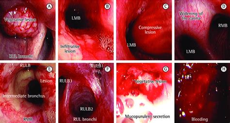 Bronchoscopy Findings