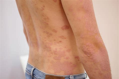 Psoriasis Eritroderma Gejala Penyebab Pengobatan Hello Sehat