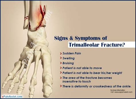 Trimalleolar Fracture Causes Signs Symptoms Treatment Conservative