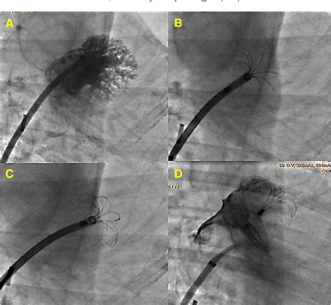 Figure 1 From Preclinical Evaluation Of A New Left Atrial Appendage