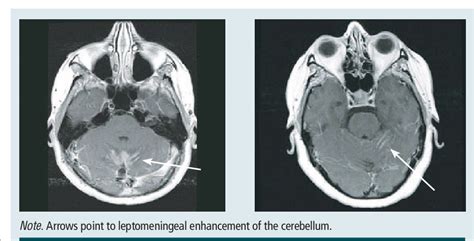 Figure 1 From Diagnosis And Management Of Leptomeningeal Disease