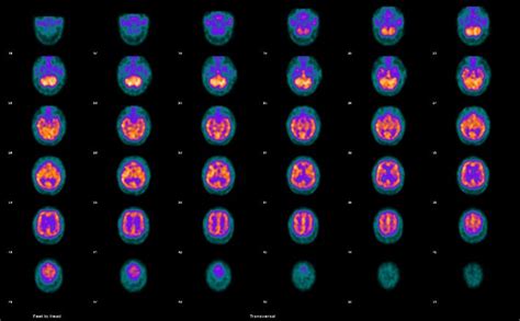 The Significance Of Brain Hypoperfusion