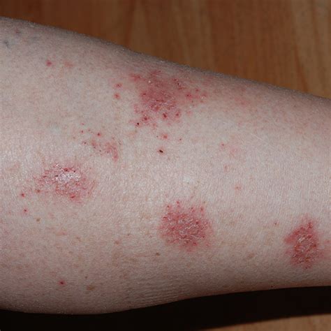 Dermatitis Numular Doctor Valdés