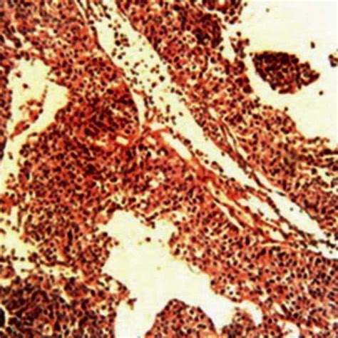 Lowgrade Papillary Urothelial Carcinoma Of The Bladder H And E Download Scientific Diagram