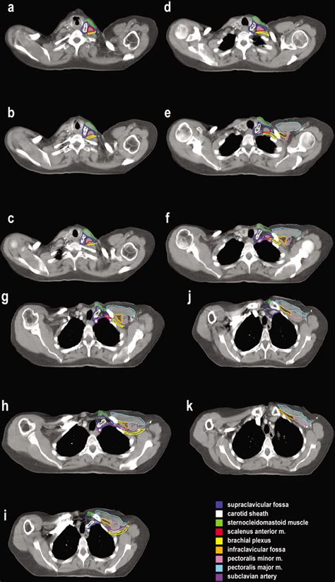 Supraclavicular Lymph Nodes