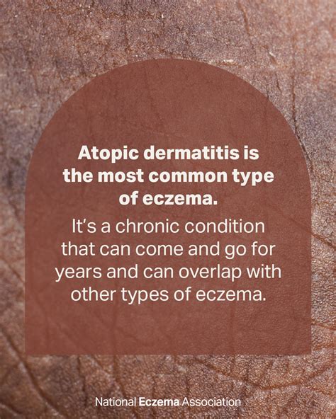 National Eczema Association National Eczema Association
