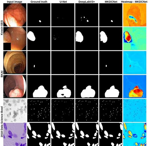 Qualitative Results Comparison Along With The Heatmap On The Kvasir Seg