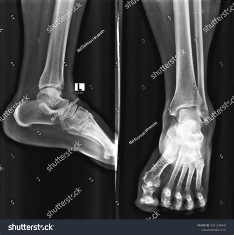 Hinge Joint Human Images Stock Photos Vectors Shutterstock