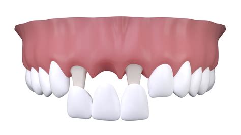 Single Tooth Implant Procedure Risks And Cost
