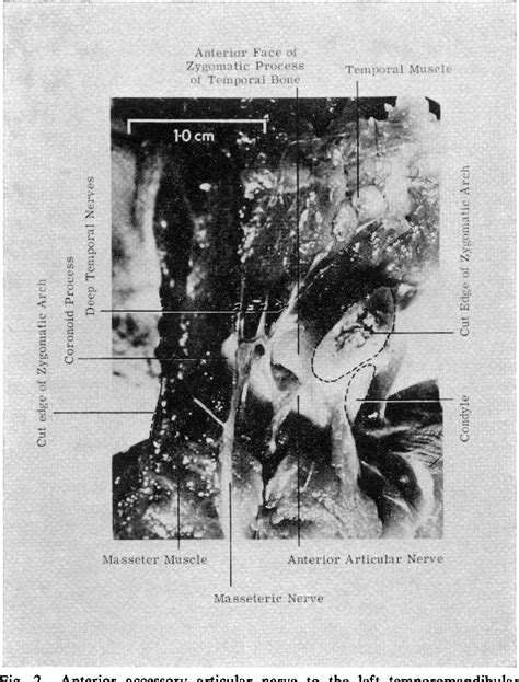 Figure 2 From Structure And Function Of Temporomandibular Joint Innervation Semantic Scholar