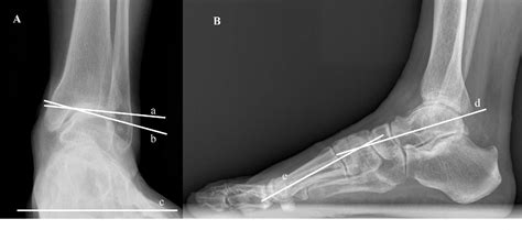 Figure 1 From Relationship Between Ankle Varus Moment During Gait And
