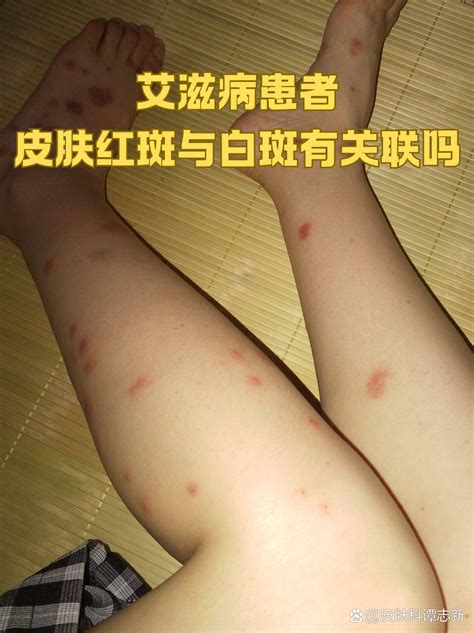 艾滋病患者，皮肤红斑与白斑有关联吗