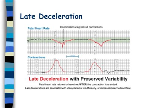 Fetal Decelerations What Is It Causes And More Osmosis 55 Off