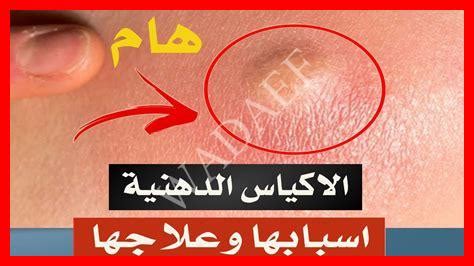 ما سبب ظهور حبة في فتحة المؤخرة
