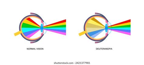 Tritanopia Vision Color Blindness Infographic Human Stock Vector
