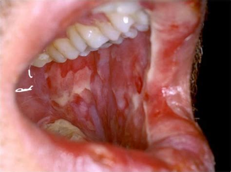 Enrollment Continues In Study Of Oral Mucositis Medication Dentistry