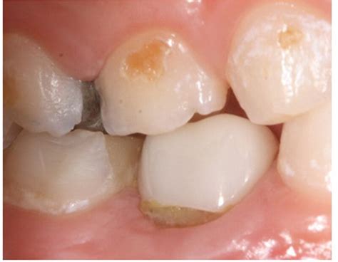 Loss Of Marginal Integrity On Lower Deciduous First Molar When Restored