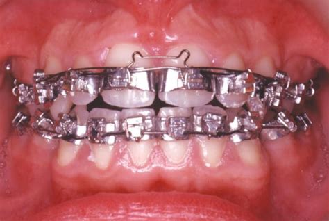 Teeth Braces History At Sandra Raines Blog