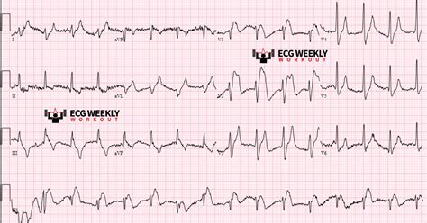 Stat Ecg Diagnoses Right Ventricular Hypertrophy Criteria Electrical Alternans Vs Respiratory