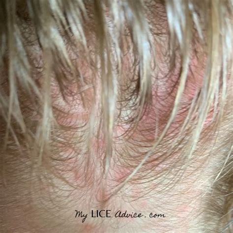 Head Lice Bites