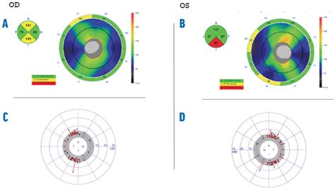 Structure And Function In Early Glaucoma Diagnosis Modern Optometry