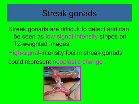 Role Of Imaging In Ambiguous Genitalia Ppt Endocrine And Metabolic Role Of Imaging In Ambiguous Genitalia Ppt Endocrine And Metabolic