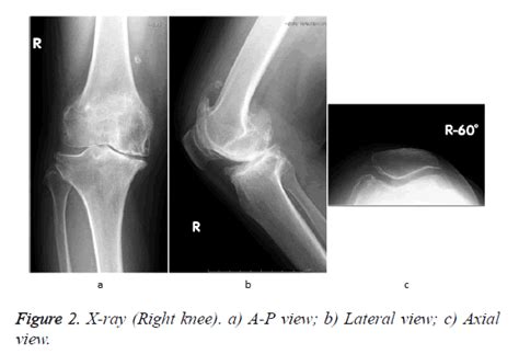 L Shaped Tibial Condylar Valgus Osteotomy For Advanced Medial Knee