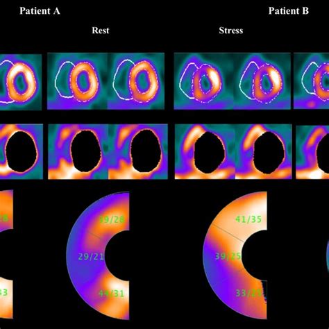 Two Sample Patients Right And Left Ventricular Segmentation By Download Scientific Diagram