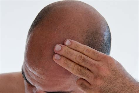 Dry Flaky Scalp Remedy Dry Flaky Scalp Thick Hair Remedies Hair Protein Treatment Products