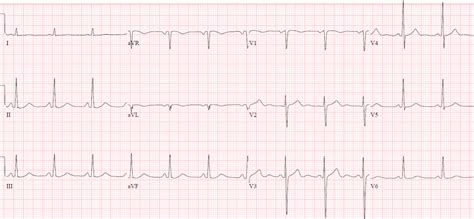 Hyperacute T Waves And Occlusion Mi Ecg Cases Emergency Medicine Cases