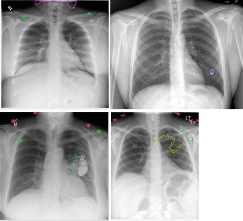 Foreign Objects Annotatedlabeled In Chest X Rays Jewelry Buttons