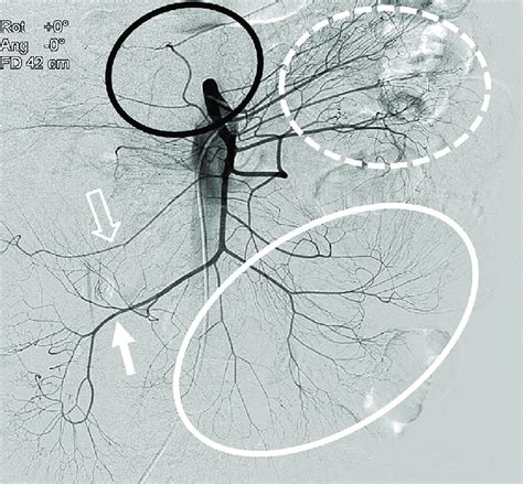 Superior Mesenteric Angiogram For Suspected Active Bleeding From A Download Scientific Diagram