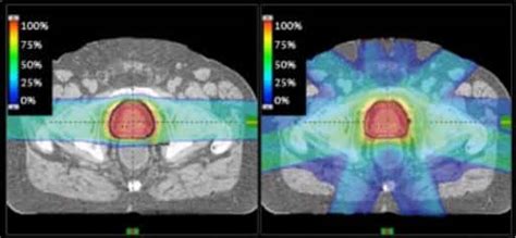 Proton Beam Treatment For Prostate Cancer The Best Picture Of Beam