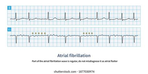 Atrial Fibrillation Vs Atrial Flutter