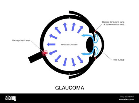 Glaucoma Diagram Cut Out Stock Images And Pictures Alamy