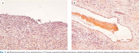 Figure 2 From Giant Angiomatous Choanal Polyp Originating From The