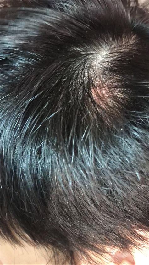 Is This Ringworm It Is Itchy Sheds Flaky Skin And Moist Rringworm