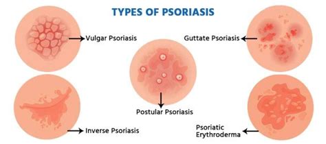 Psoriasis Nurses Revision