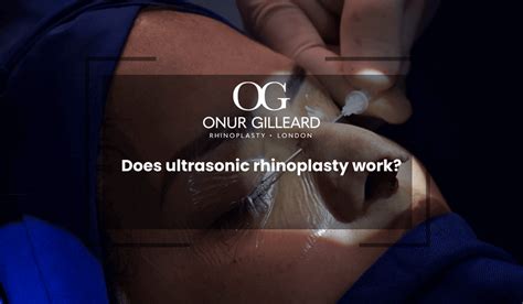 Does Ultrasonic Rhinoplasty Work — Onur Gilleard