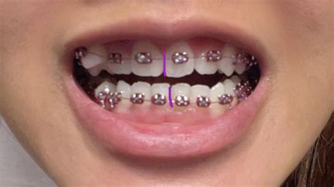 Cant Wait To See My Midline Aligning Im Only On My 5th Day Anyone