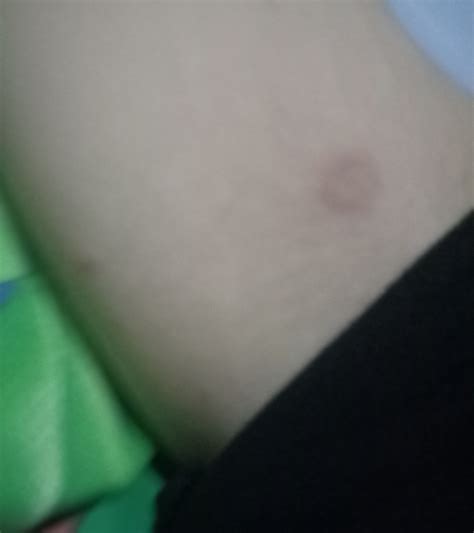 Gatal Gatal Hellosehat