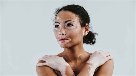 Vitiligo Causas Sintomas E Tratamentos