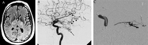 A Fluid Attenuated Inversion Recovery Mri Showing Patchy