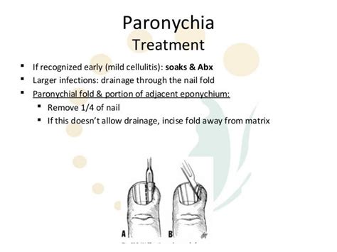 Chronic Paronychia Home Treatment