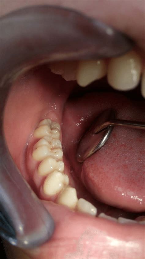 The Second Molar Of The Lower Jaw Men Download Scientific Diagram