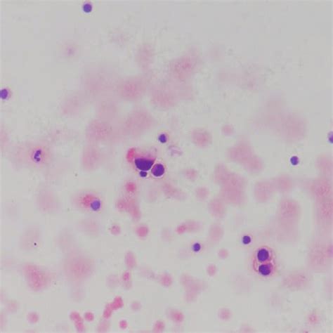 Csf Smear Hematoxylin And Eosin Staining ×100 A A Baseline Csf