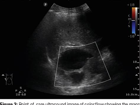 Figure 1 From Cystic Pheochromocytoma With Hypertensive Crisis And